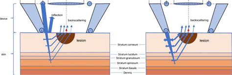 Classification Of Melanocytic Lesions Using Direct Illumination Multispectral Imaging