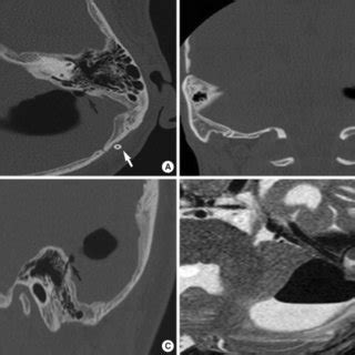 High Resolution CT Scan Of The Temporal Bones A Axial Finding Shows Download Scientific
