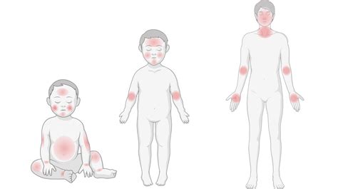 Atopisk Eksem Ugeskriftet Dk