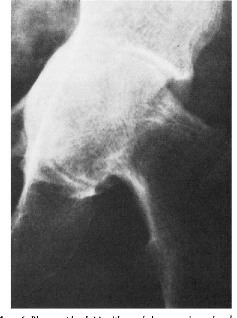 Buttressing Bone