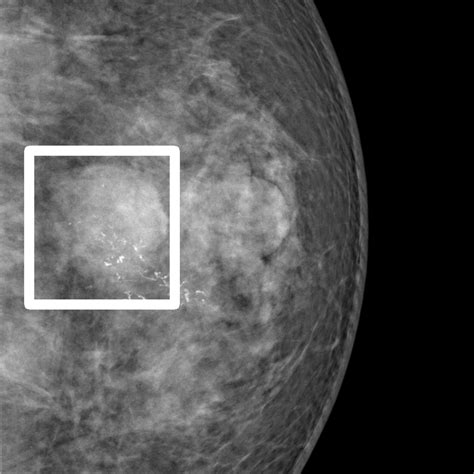 Mammogram Mass Analyzer Desktop App Kaggle