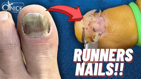 Runners Toenail Problems Toenail Infection Healthdirect