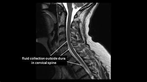 Csf Leak Surgery Recovery Mapametawan