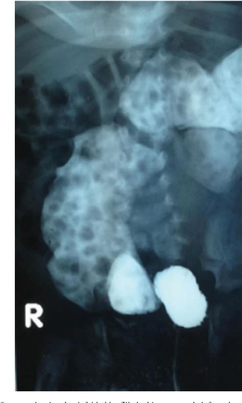 Figure 2 From Complete Penile Duplication With Structurally Normal Penises A Case Report