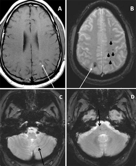 Multiple Cavernous Malformations In Our Patient A And B Cavernous