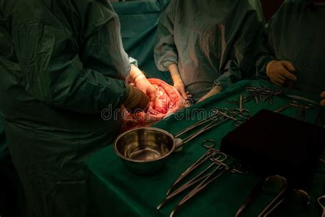 Surgical Team Performs A Surgical Abdominal Operation Stock Image Image Of Abdominal Hernia