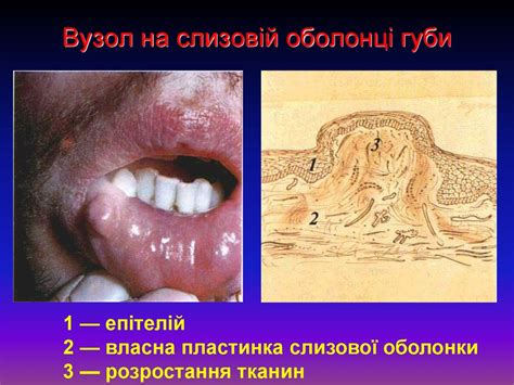 Слизова оболонка порожнини рота Будова функції Патологічні процеси що виникають на слизовій
