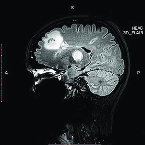 Brain Mri Axial Documenting Hyperintense Tumefactive Lesions Of