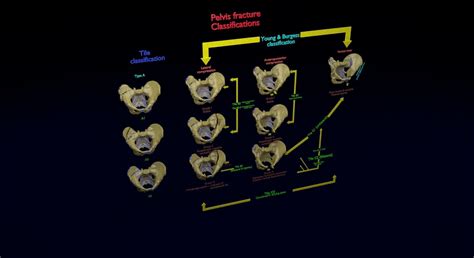 Pelvis Fracture Classifications 3d Model Superhive Formerly Blender