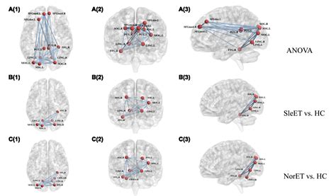 Table 1 From Disrupted Brain Functional Network Topology In Essential Tremor Patients With Poor