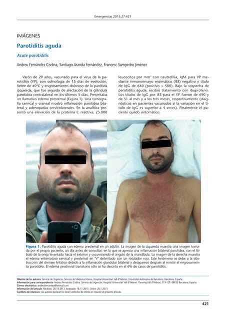 Pdf Parotiditis Aguda