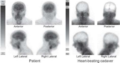 The Localization Of Lesions Causing Coma Neupsy Key