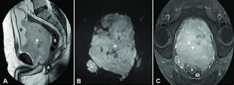 Multiparametric Prostate Mr Images In A 45 Year Old Male Patient With Download Scientific