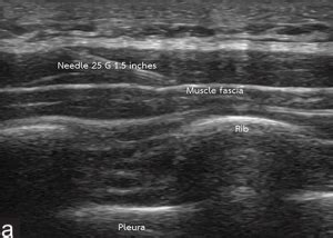 Ultrasound Guided Periscapular Trigger Point Injection Sports Medicine Review