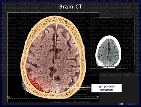 Brain Ct Right Posterior Hematoma Trialquest Inc