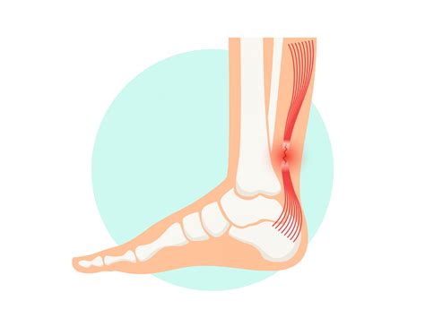 Toa Foot And Ankle Achilles Tendon Rupture Toa