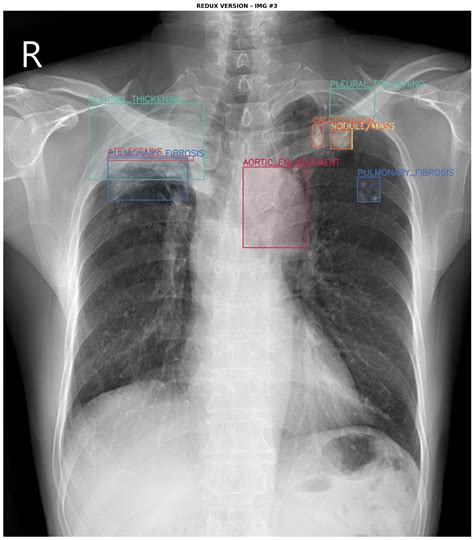 Github Indswetrustvinbigdatachestxrayabnormalitiesdetection