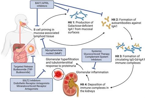 Proposed Four Hit Hypothesis Of Igan Pathogenesis And Current