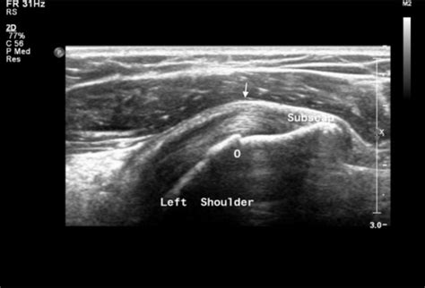 Subscapularis Tendon