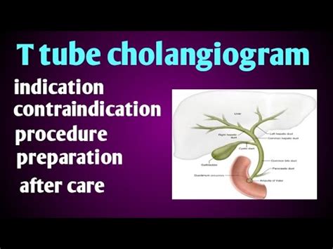 T Tube Cholangiogramx Ray Procedure T Tube Cholangiogramcholicestectomycontrast Media YouTube