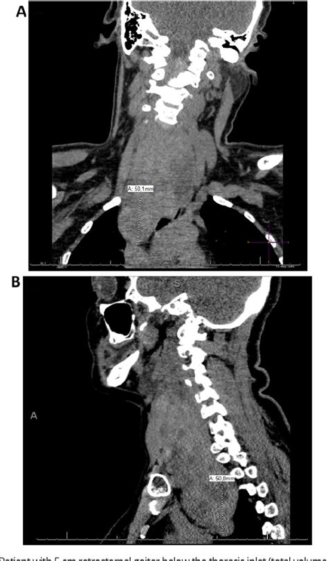 Figure 1 From Does The Diameter Of The Thoracic Inlet Influence The