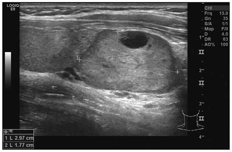 Parathyroid Tumor Ultrasound