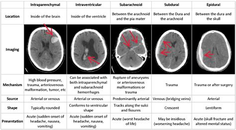 Intracranial Haemorrhage Detection Using Deep Learning By Gopal B