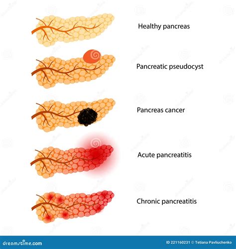 Pancreas Disease And Cancer Stock Vector Illustration Of Pseudocyst