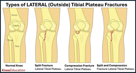 Tibial Plateau Fractures Knee Education