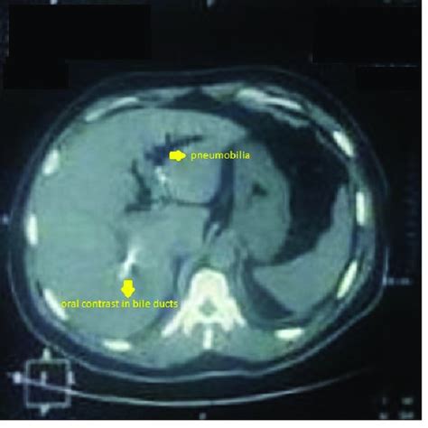 Ct Scan Showing Oral Contrast In The Intrahepatic Bile Ducts And