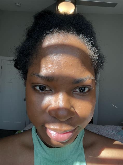 Tiny Bumps All Over Face Rskincareaddicts
