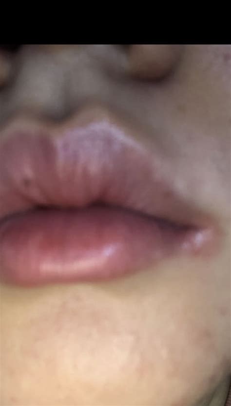 Angular Cheilitis Scars