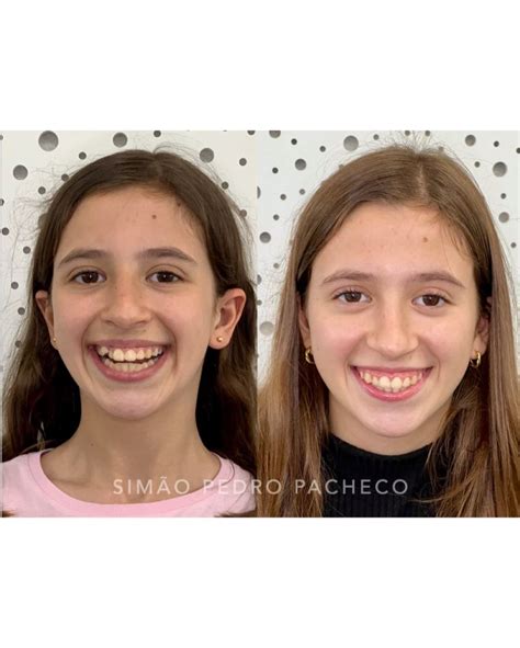 Simão Pedro Pacheco On Linkedin 🇬🇧 This A A Typical Case Of Class Ii