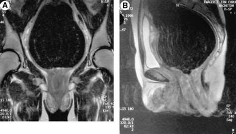Clitoral Hypertrophy Caused By A Leiomyoma Extending To The Vulva And