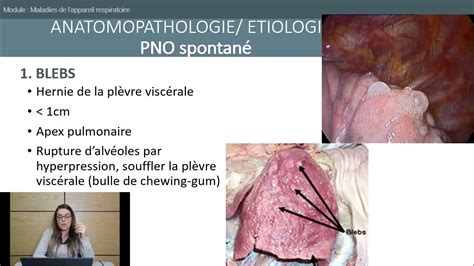 Pneumothorax Ep1 Youtube