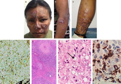 Disseminated Cutaneous Lesions In An Immunocompromised Patient A