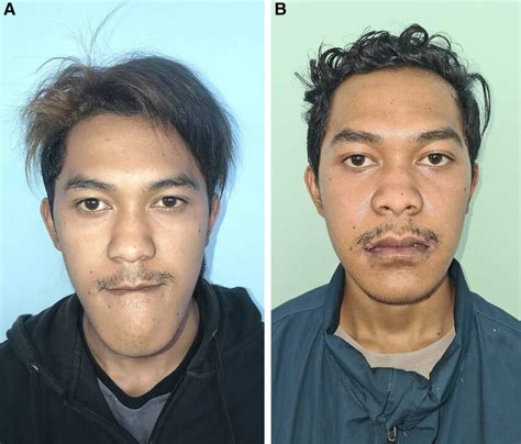 A Preoperative Photograph Of A 20 Year Old Man With Bilateral