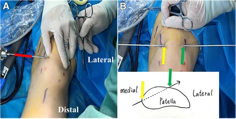 Reconstruction Of The Medial Patellofemoral Ligament Through A Double