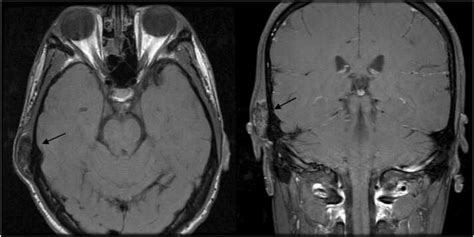 Parosteal Osteosarcoma Of The Skull Pathophysiological And Imaging Review Pmc