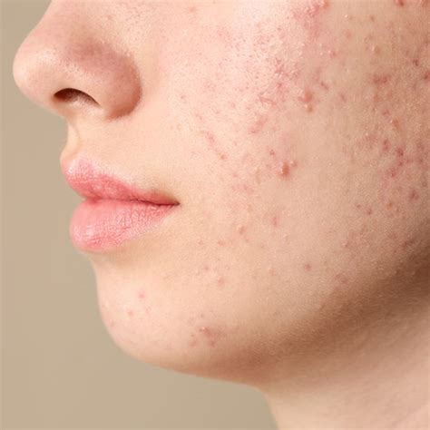 Effectively Treat Acne And Blemishes In Alberta Zia