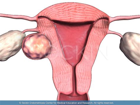 Fibroids Types Causes And Symptoms Dr Seckin