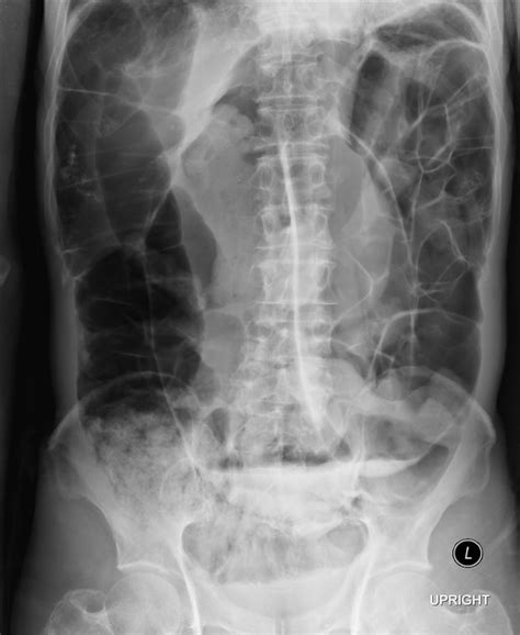 Sigmoid Colon Volvulus Coffee Bean Sign