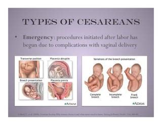 Babies On Demand Cesarean Delivery By Maternal Request Pdf