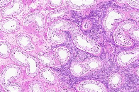 Pathology Outlines Dlbcl Primary Testicular