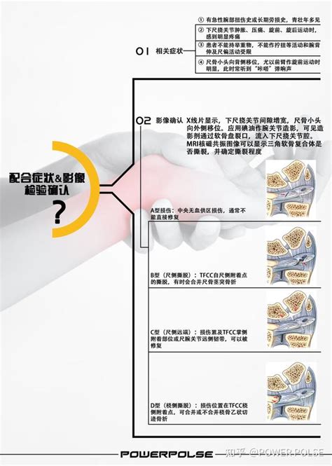 手腕tfcc损伤全攻略，跟着思维导图逐步康复！ 知乎