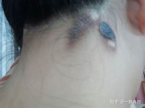 冷冻治疗淀粉样皮肤样变 知乎