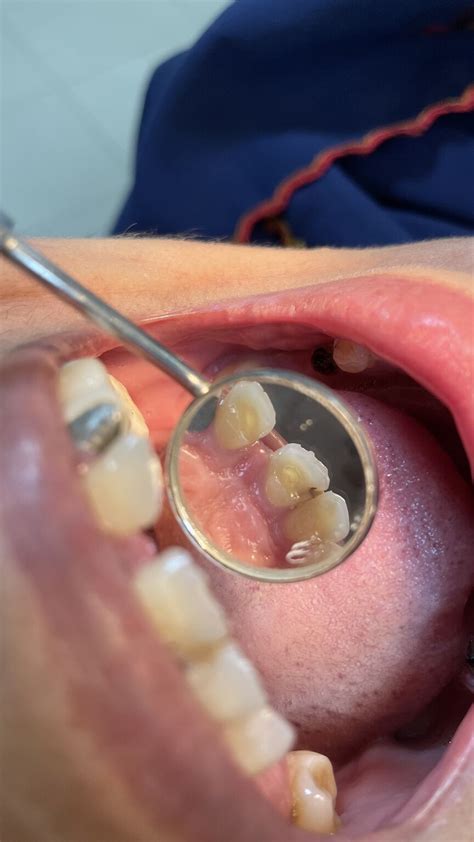 Root Canal Treat On Upper Central Incisor In A 69 Year Old Female
