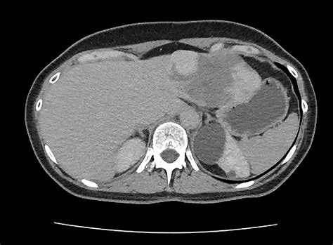 Cavernous Hemangioma Liver Ultrasound
