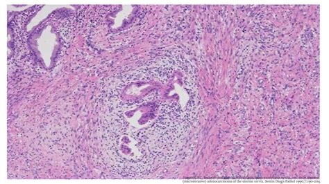 Clasificación Histopatológica Del Cáncer Cérvicouterino Gilr6 Pptx