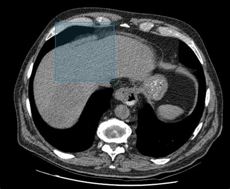 Referencedseriessequence Tag Missing Via Using Writer To Generate A Dicom Seg From A Numpy Array